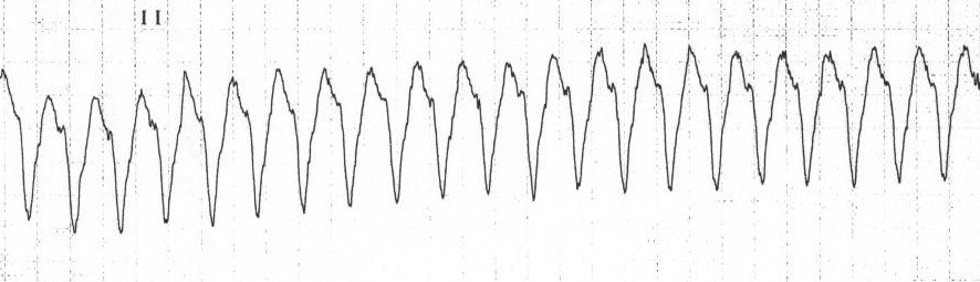 VT-rhythm-strip – Acilci.Net