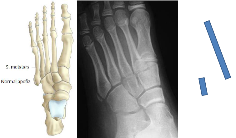 5. Metatars Kırıkları | Acilci.Net