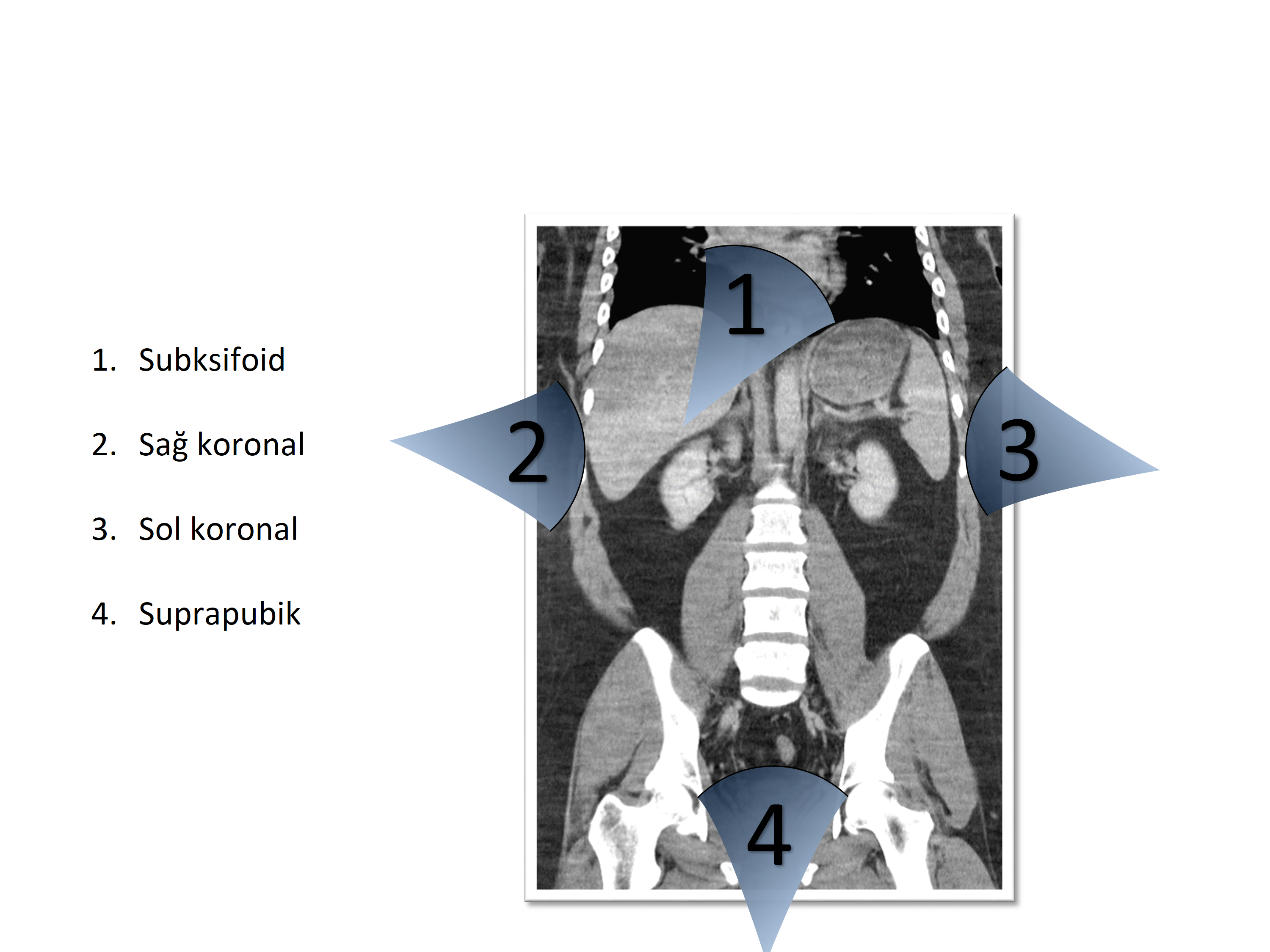 Temel Ultrasonografi – EFAST - Acilci.Net