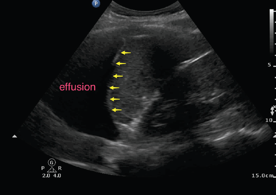 Ultrason: Akciğer Odaklı Değerlendirme - Acilci.Net